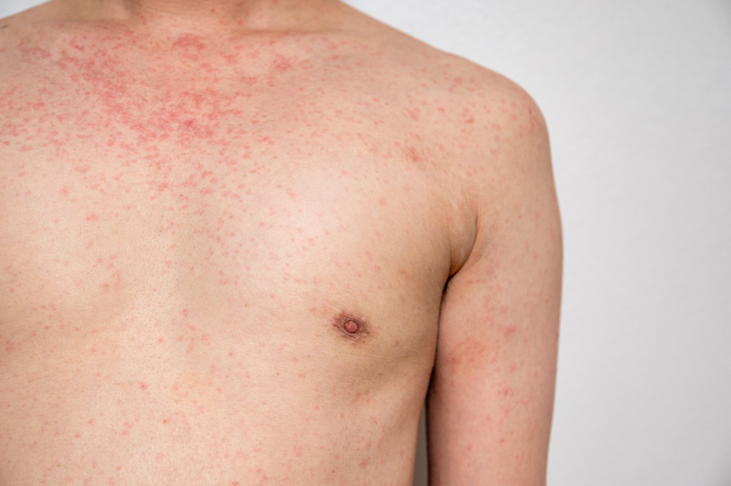 Measles advice - Mid and South Essex Integrated Care System