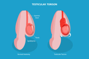 Testicular Torsion: Important information for young people and parents ...